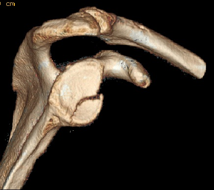 Scapula Fractures - Trauma - Orthobullets