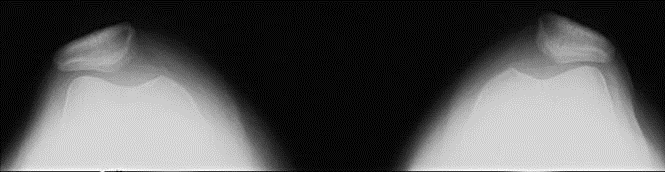 Articular Cartilage Defects of Knee - Knee & Sports - Orthobullets