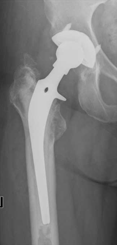 THA Prosthesis Design : 네이버 블로그