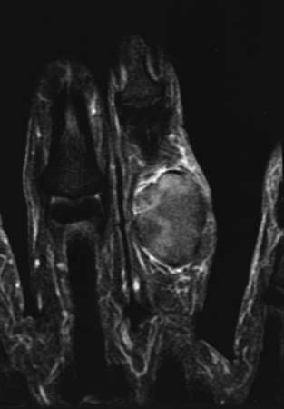 Giant Cell Tumor of Tendon Sheath - Hand - Orthobullets