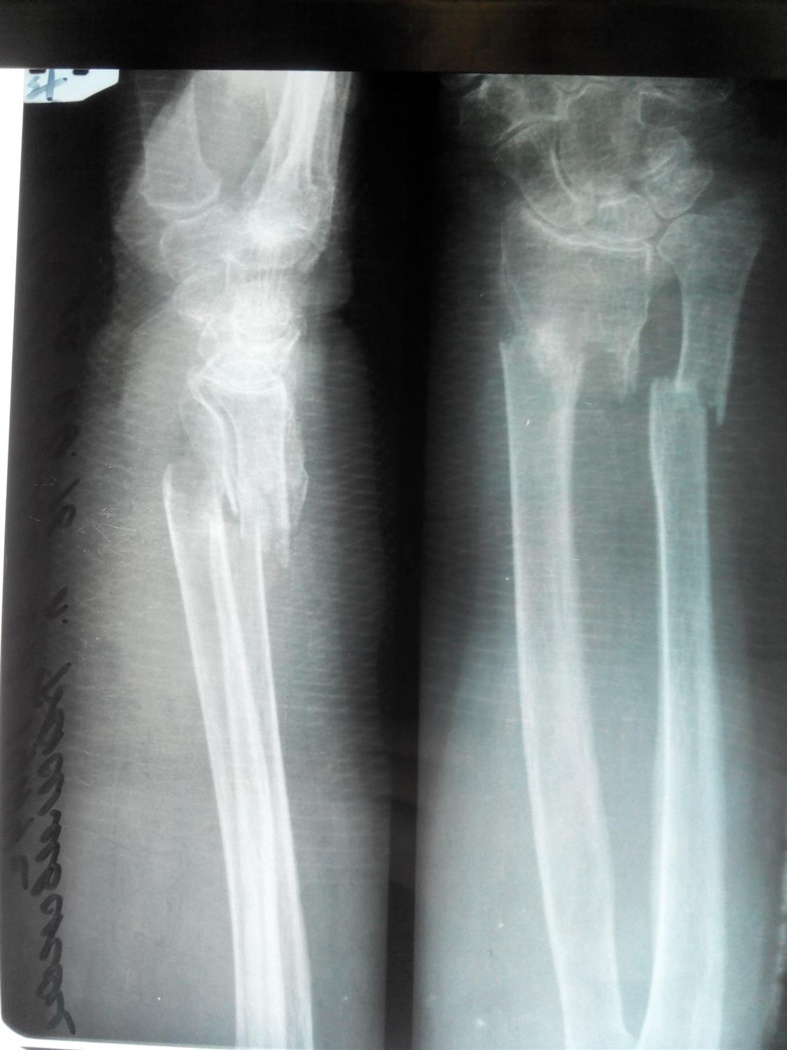 Distal Radius Fractures Trauma Orthobullets