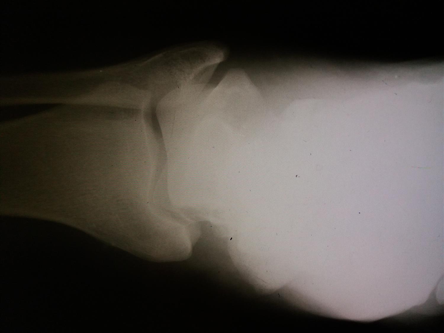 Talar Neck Fractures - Trauma - Orthobullets