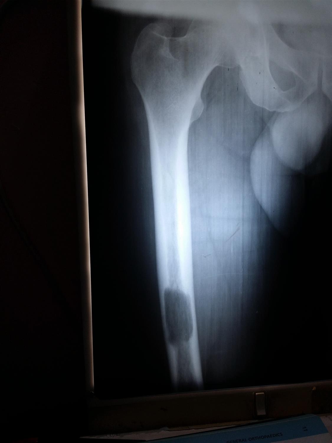 Unicameral Bone Cyst - Pathology - Orthobullets