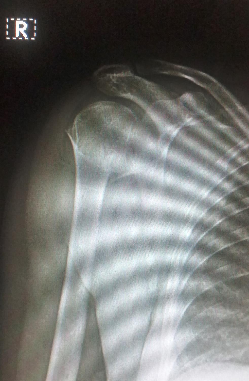 Proximal Humerus Fractures - Trauma - Orthobullets