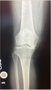 Unicompartmental Knee Replacement - Recon - Orthobullets