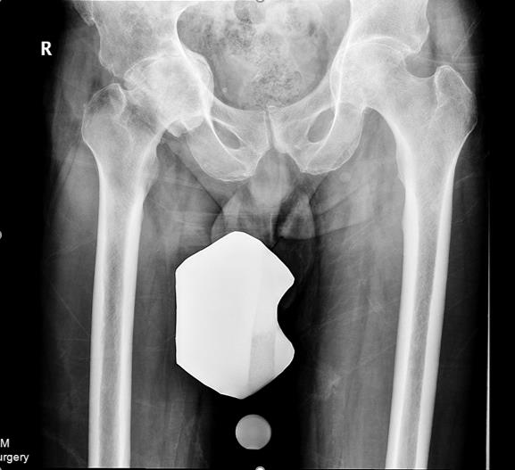 Hip Osteoarthritis - Recon - Orthobullets