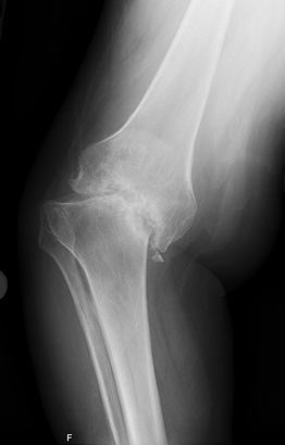 Knee Osteoarthritis - Recon - Orthobullets