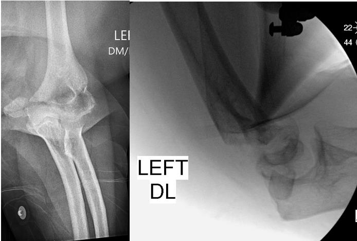 Distal Humerus Fractures - Trauma - Orthobullets