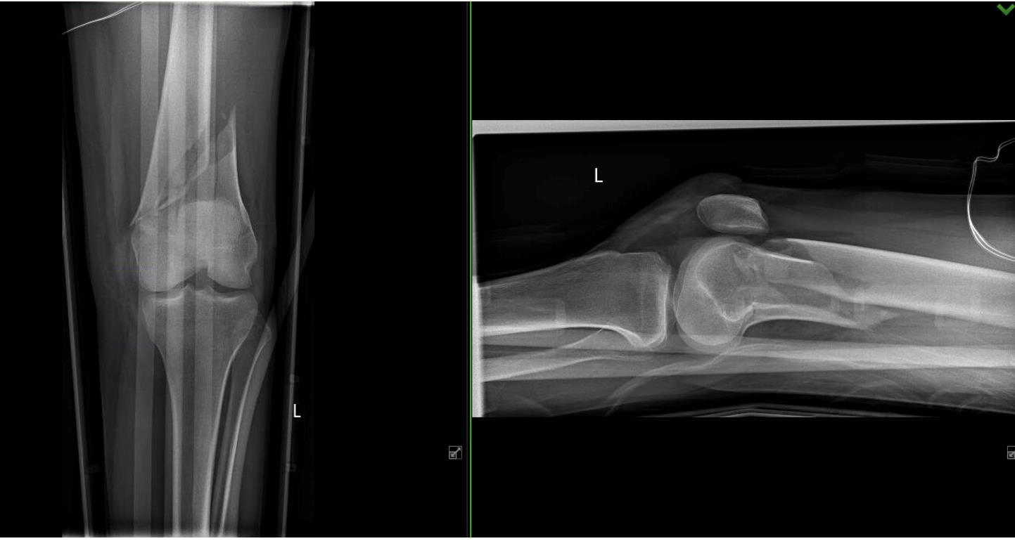 Acetabular Fractures - Trauma - Orthobullets