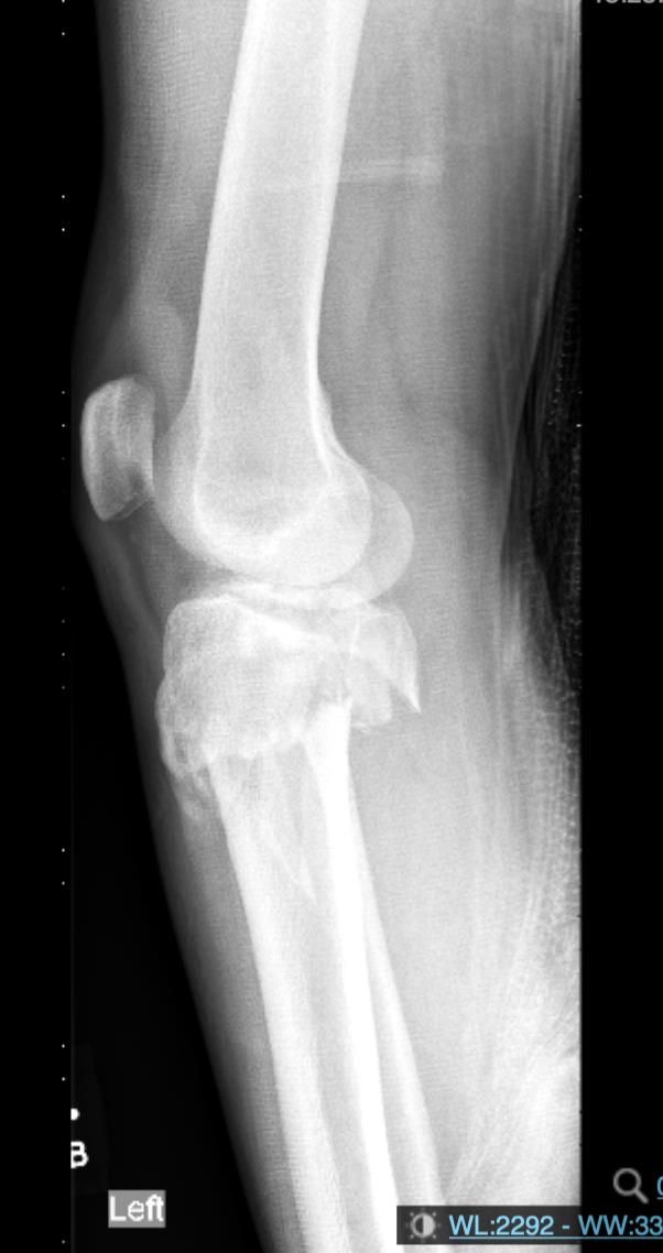 Acetabular Fractures - Trauma - Orthobullets