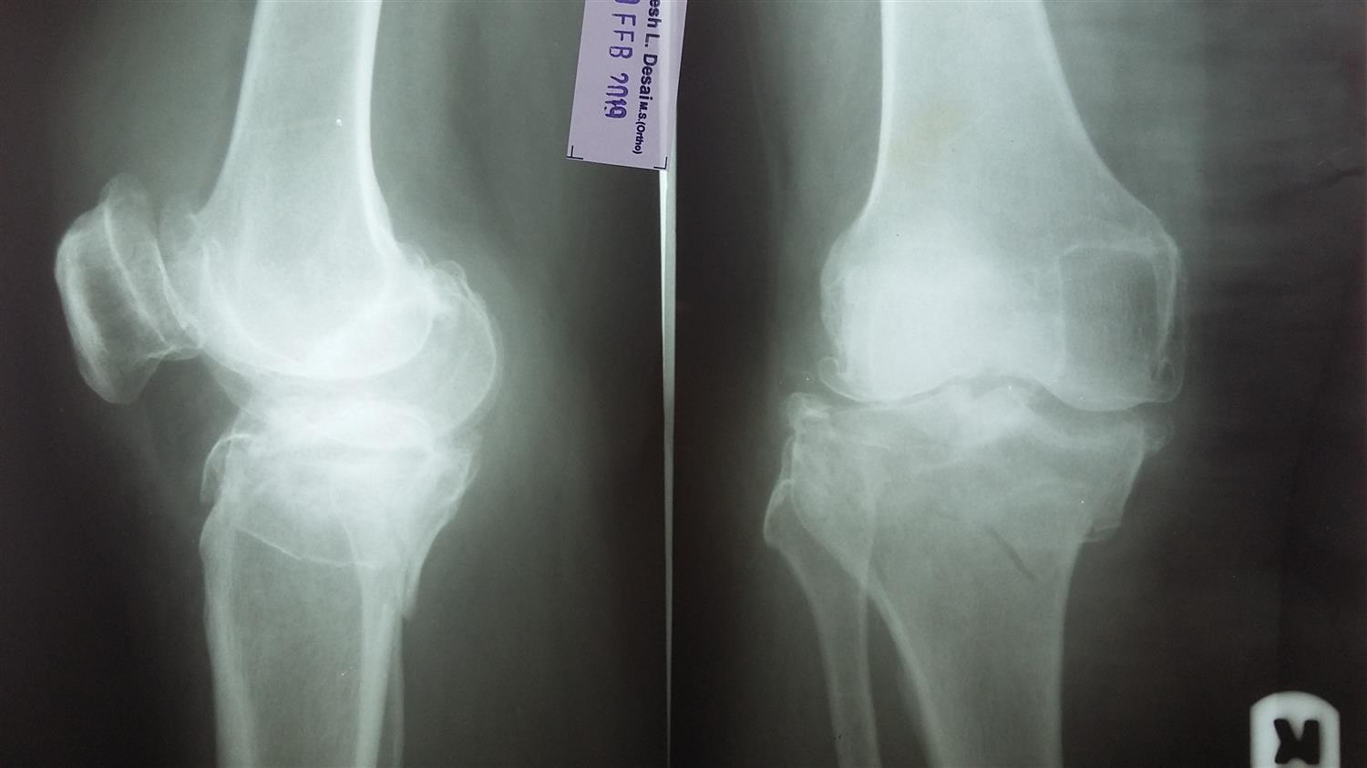 Tibial Plateau Fractures - Trauma - Orthobullets
