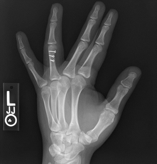 Case - Ring Finger Proximal Phalanx Fracture in 16M