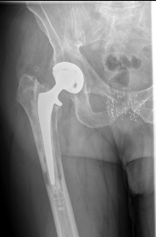 Wear & Osteolysis Basic Science - Recon - Orthobullets