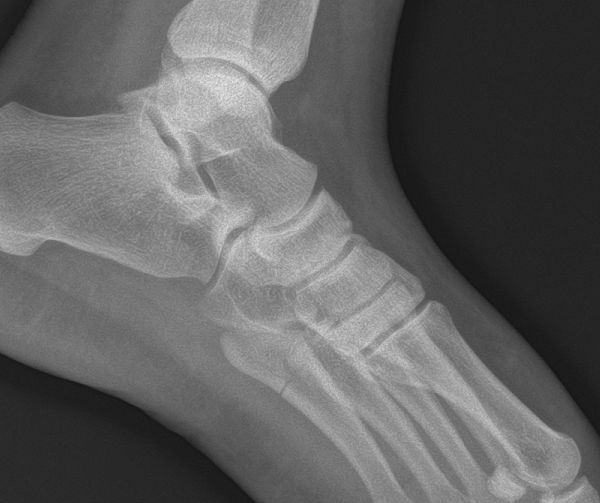 Jones Fracture Orthobullets