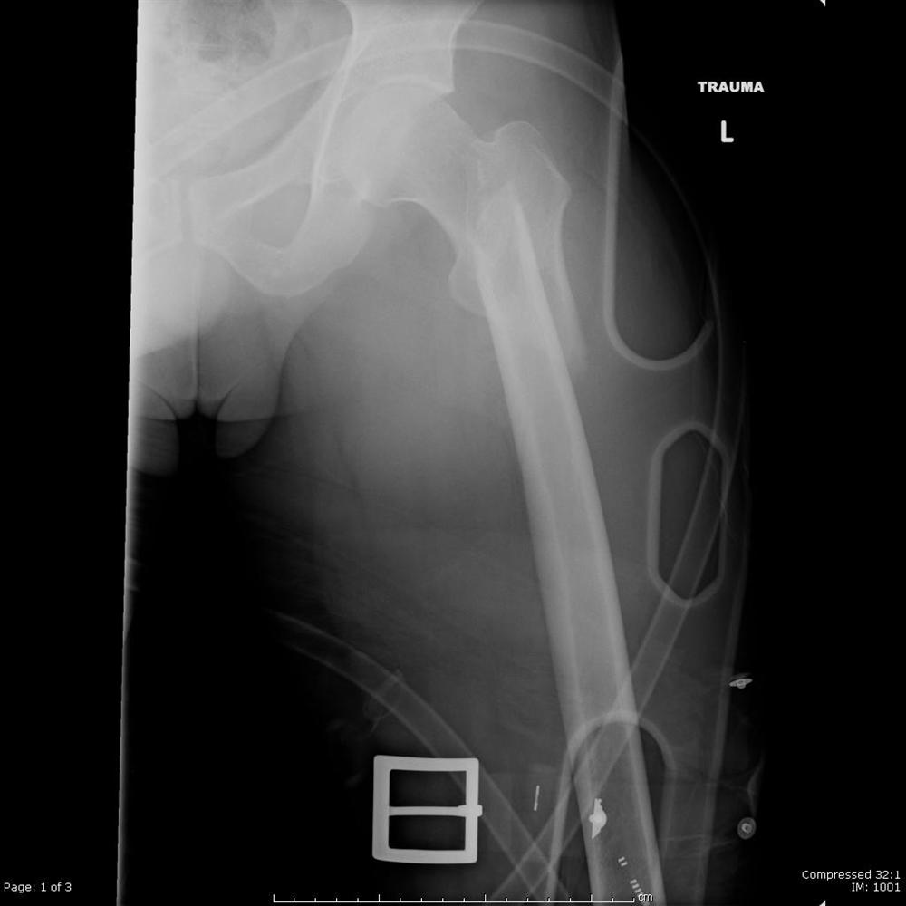 Subtrochanteric Fractures - Trauma - Orthobullets
