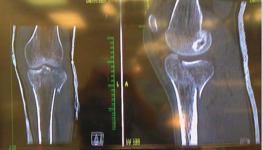 Tibial Plateau Fractures - Trauma - Orthobullets