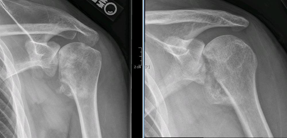 Proximal Humerus Fractures - Trauma - Orthobullets.com