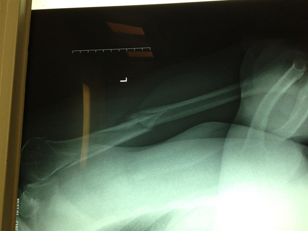 Humeral Shaft Fractures - Trauma - Orthobullets