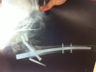 Intertrochanteric Fractures - Trauma - Orthobullets