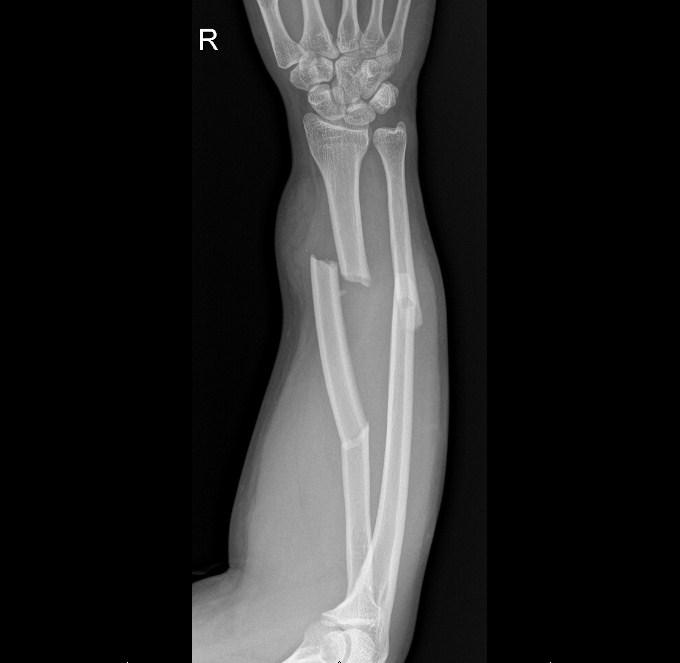 Radius and Ulnar Shaft Fractures - Trauma - Orthobullets