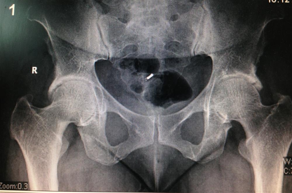 Femoroacetabular Impingement - Knee & Sports - Orthobullets