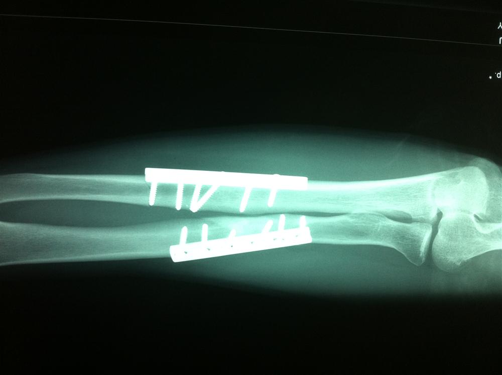 Radius and Ulnar Shaft Fractures - Trauma - Orthobullets