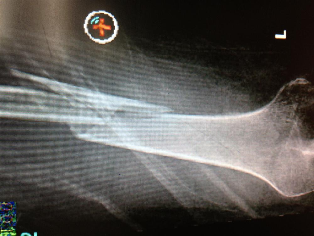 Femoral Shaft Fractures - Trauma - Orthobullets.com