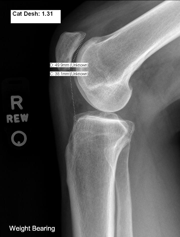Lateral Patellar Compression Syndrome - Knee & Sports - Orthobullets