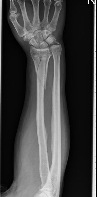 Distal Radius Fractures - Trauma - Orthobullets.com