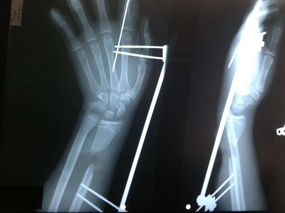 Distal Radius Fractures Trauma Orthobullets