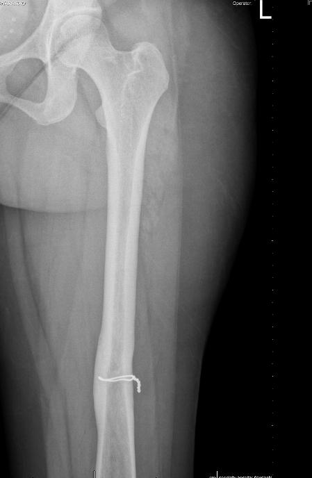 TKA Coronal Plane Balancing - Recon - Orthobullets