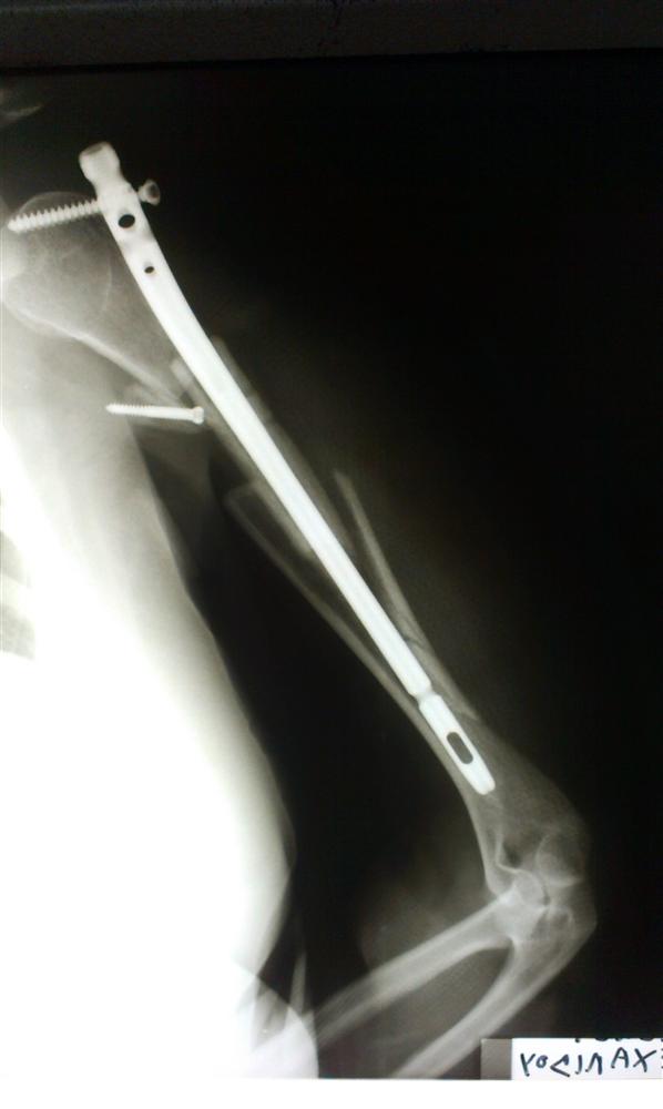 Humeral Shaft Fractures - Trauma - Orthobullets