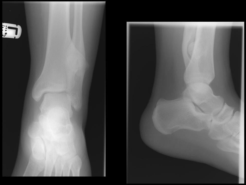 Osteochondroma & Multiple Hereditary Exostosis - Pathology - Orthobullets