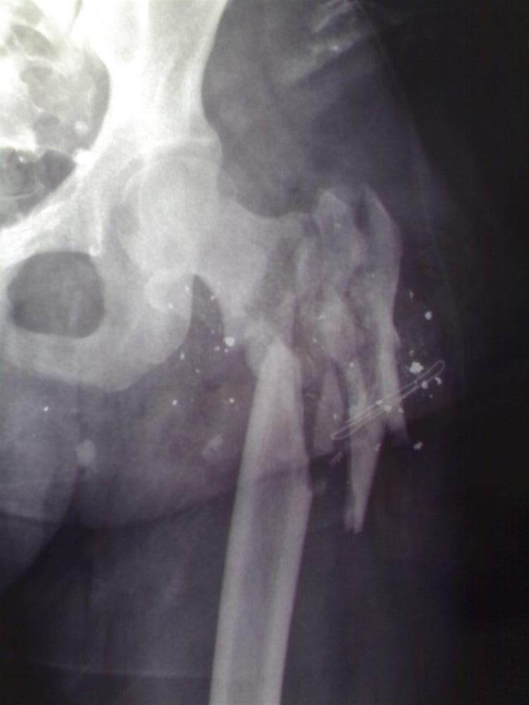 Intertrochanteric Fractures - Trauma - Orthobullets