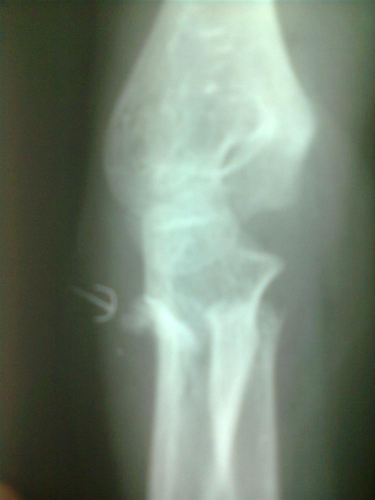 Radial Head and Neck Fractures - Pediatric - Pediatrics - Orthobullets