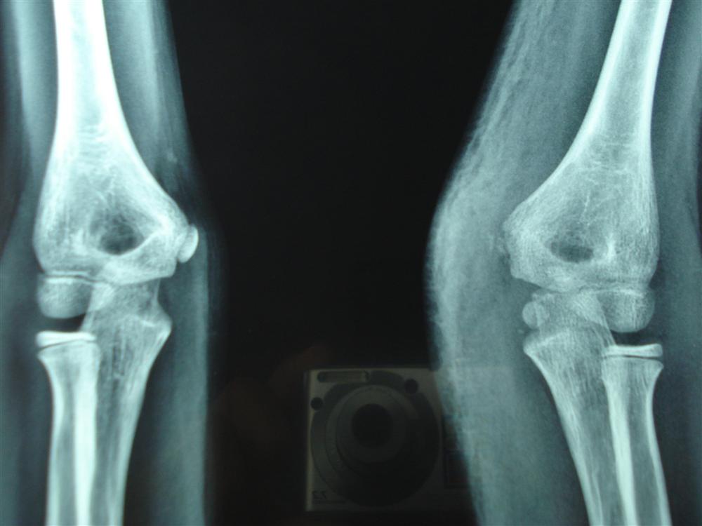 Medial Epicondylar Fractures - Pediatric - Pediatrics - Orthobullets