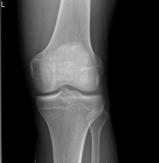 Osteochondroma & Multiple Hereditary Exostosis - Pathology - Orthobullets