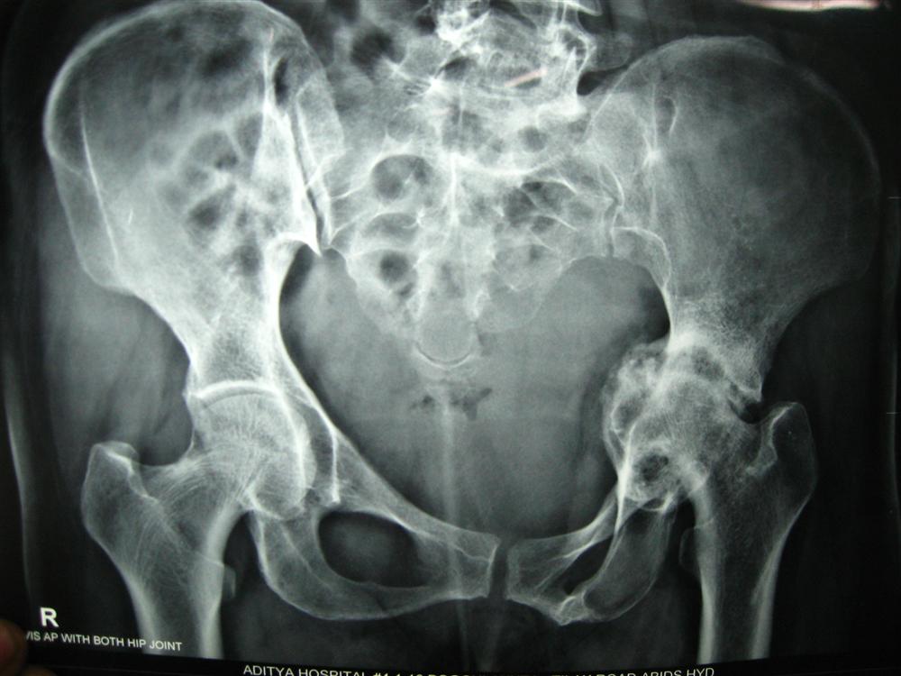 THA Acetabular Screw Fixation - Recon - Orthobullets