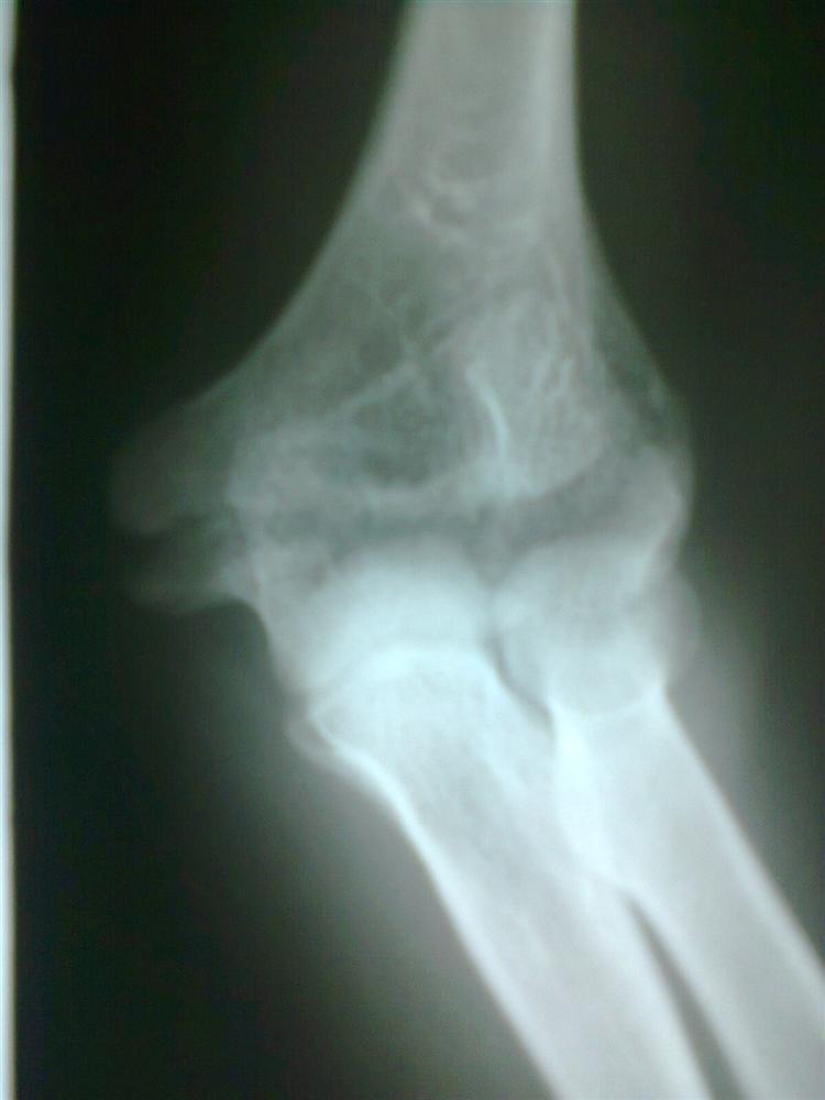 Distal Humerus Fractures - Trauma - Orthobullets