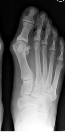 Hallux Valgus - Foot & Ankle - Orthobullets