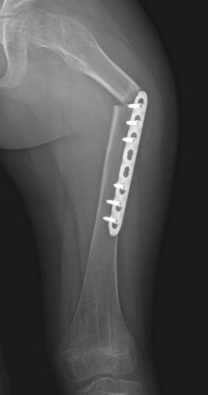 Femoral Shaft Fractures - Pediatric - Pediatrics - Orthobullets