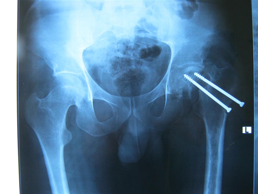 Femoral Neck Fractures - Trauma - Orthobullets.com