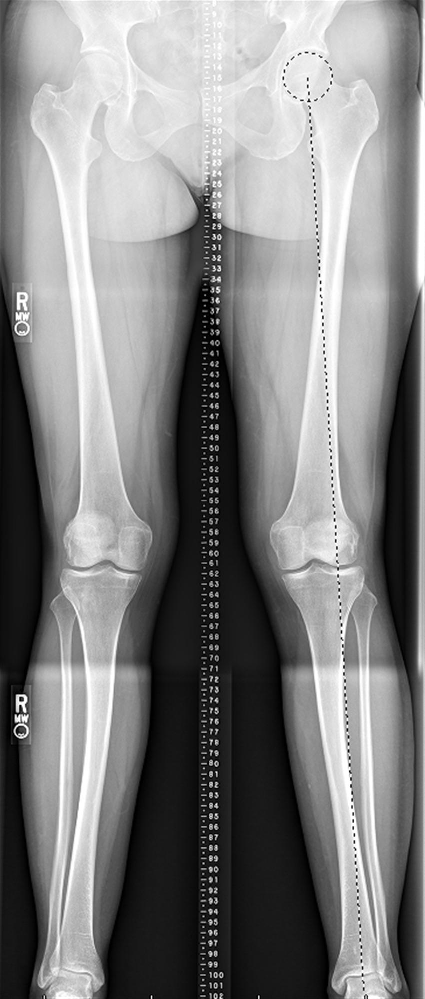 Chondromalacia Patella X-Ray at Cody Caron blog
