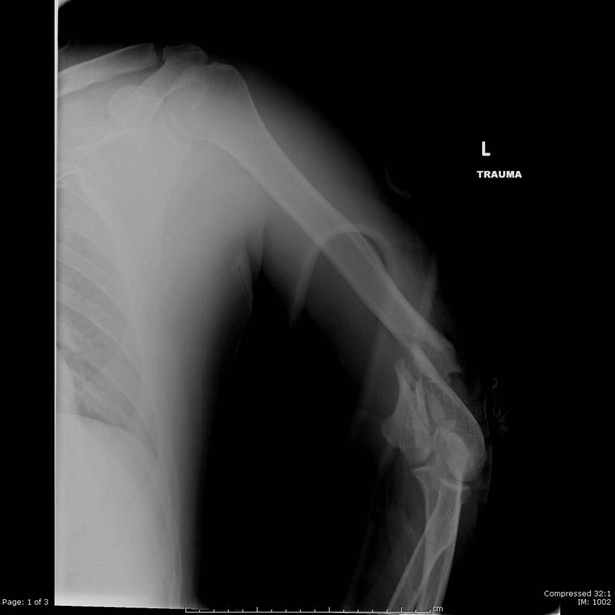 Distal Humerus Fractures - Trauma - Orthobullets