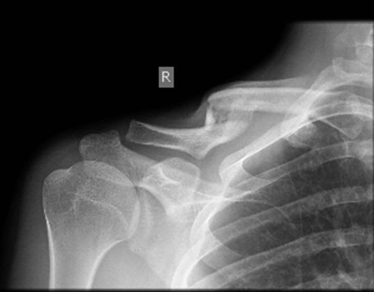 Z Deformity Clavicle Fracture at Gabriel Faulkner blog