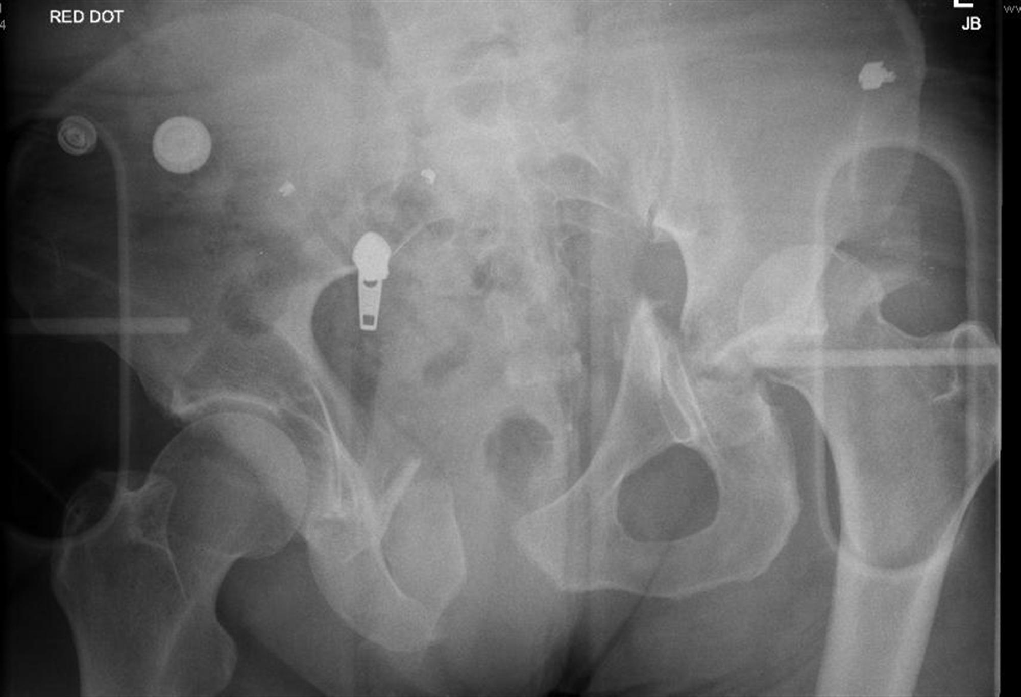 Pelvic Ring Fractures - Trauma - Orthobullets
