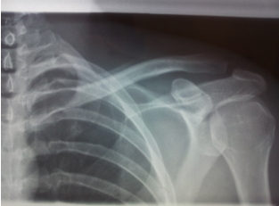 Scapula Fractures - Trauma - Orthobullets