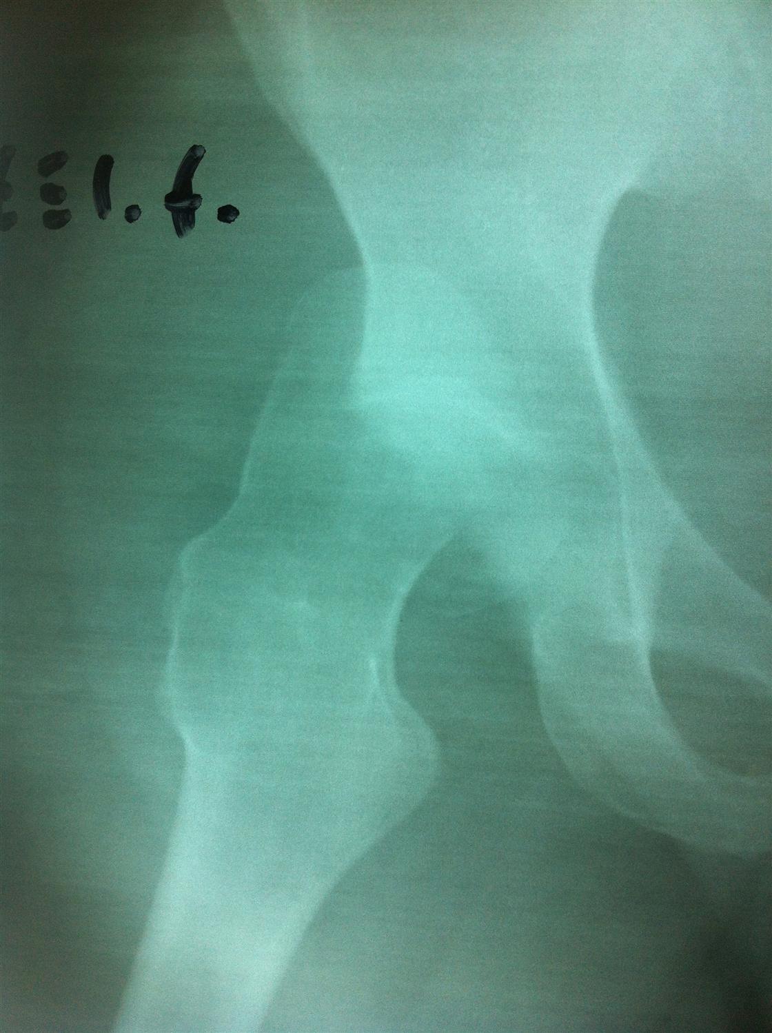 Femoral Head Fractures - Trauma - Orthobullets