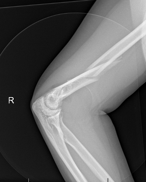 Distal Humerus Fractures - Trauma - Orthobullets