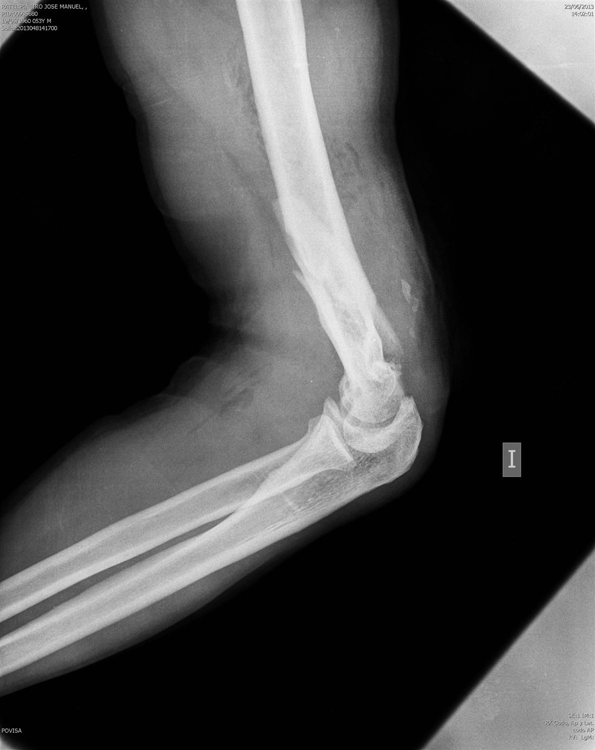 Distal Humerus Fractures - Trauma - Orthobullets